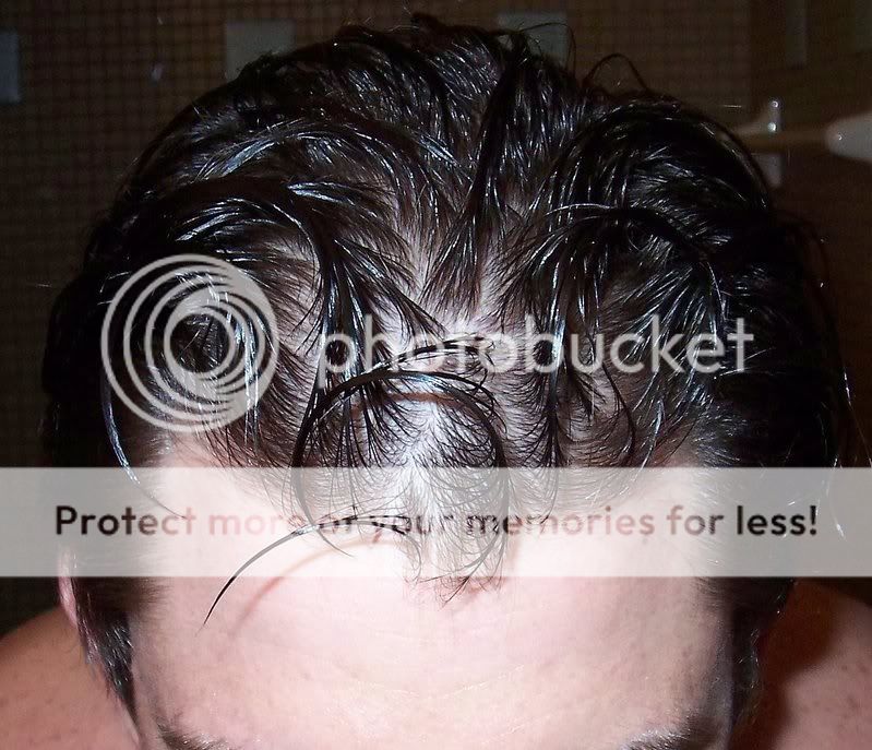 Diffuse Thinner - Can I Put Foam on This? (*Pics*) | HairLossTalk Forums